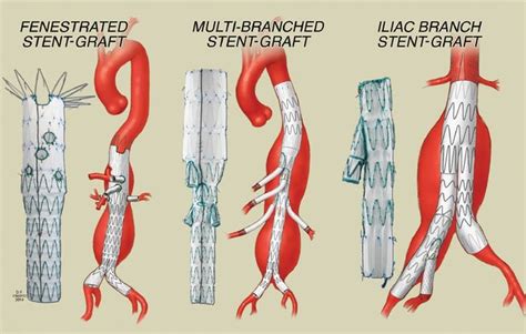 pin on vascular and endovasculare surgery