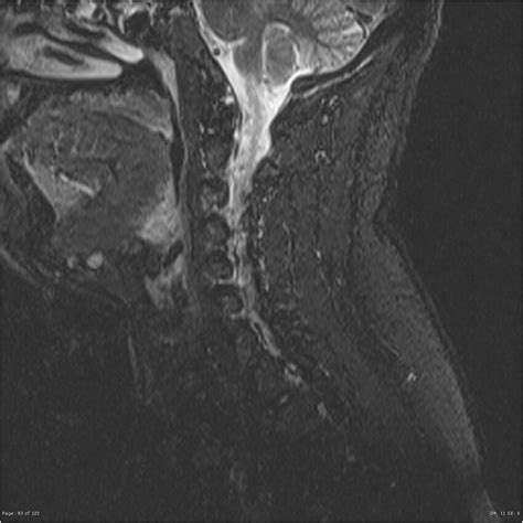 Radiopaedia Case Hemangioblastoma Cervical Cord Id 19509 Study