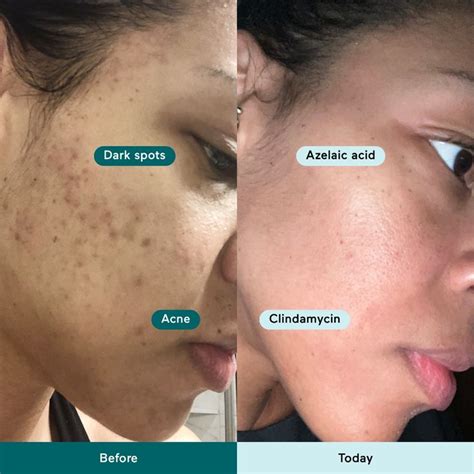 Ashely Before And Today Skin Progress Azelaic Acid Vs Tretinoin