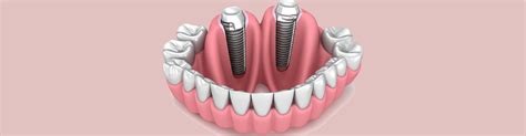 How Do Tooth Implants Prevent Bone Loss After Tooth Loss