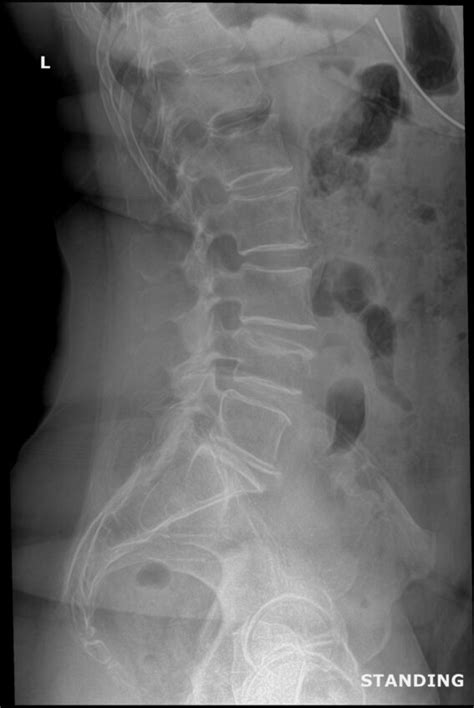 Case Study Acute Lumbar Compression Fracture Clinical Pain Advisor