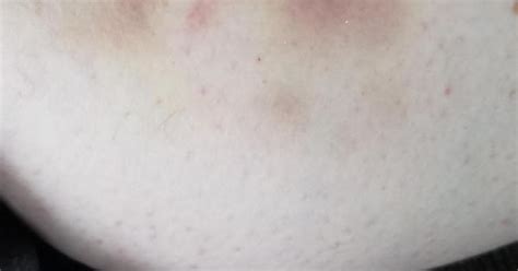 Weird Bug Bites With Bruising Album On Imgur
