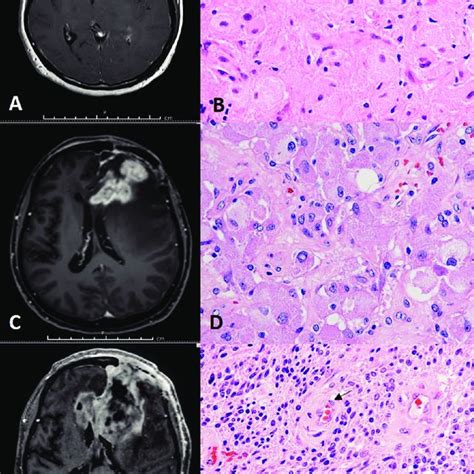 Illustrative Cases Of Malignant Transformation Of Diffuse Astrocytoma Download Scientific