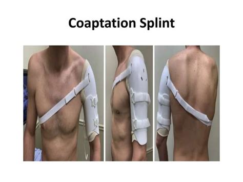 Humerus Shaft Fractur Oscepptx