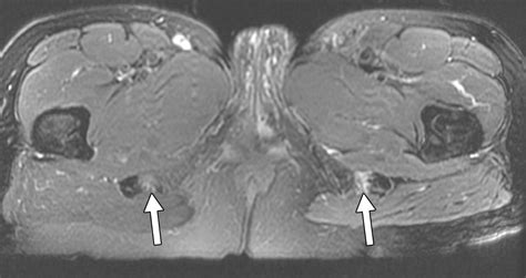 Mri Hamstring Tear Google Search Hamstrings Torn