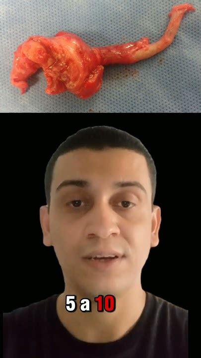 Apêndice Cecal Youtube