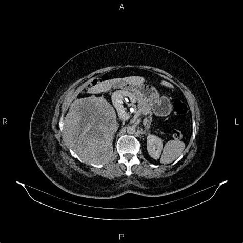 Retroperitoneal Sarcoma Nejm