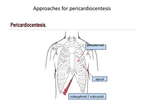 Pericardial Diseases презентация онлайн