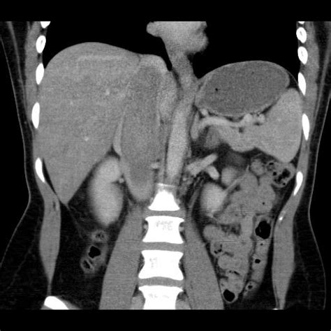 Scvs Intracardiac Leiomyomatosis A Case Report And Literature Review