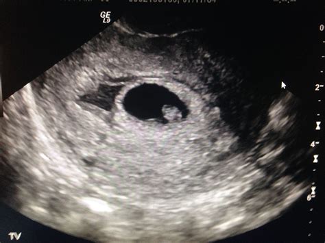 Subchorionic Hemorrhage Sonography Ultrasound Hemorrhage