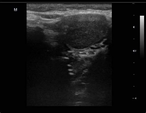 Paraganglioma Pacs