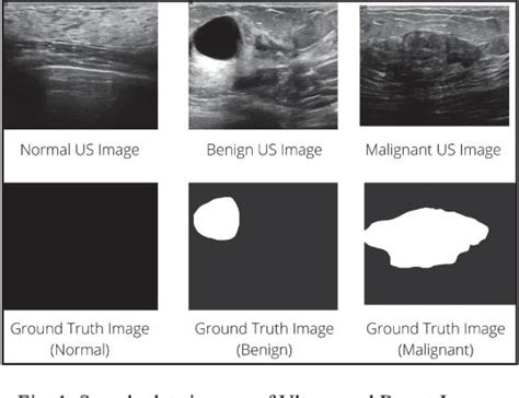 Computer Aided Breast Cancer Diagnosis Using Deep Convolutional Neural Networks Semantic Scholar