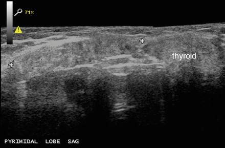 Pattern Recognition Diffuse Thyroid Disease Radiology Key
