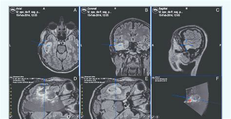 Neuronavigation Screenshot Of A Left Temporal Low Grade Glioma During