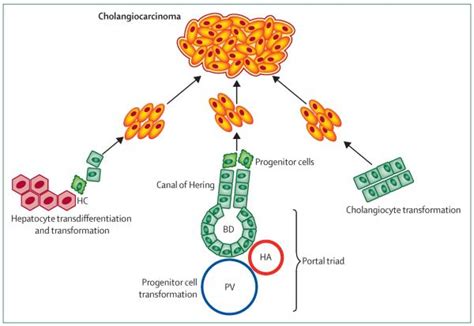 Cholangiocarcinoma Pmc