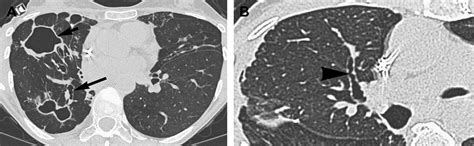 Bronchiectasis Thoracic Surgery Clinics