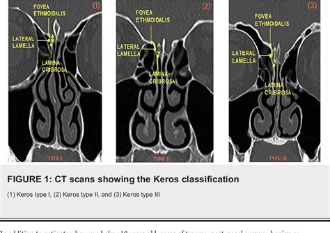 Figure 1 From Evaluation Of The Keros Classification Of Olfactory Fossa By Ct Scan In Qassim