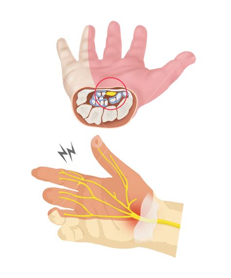 손목 수근관증후군 손목터널증후군 해부학 증상 사진 이미지 일러스트 캘리그라피 Nchuccida작가