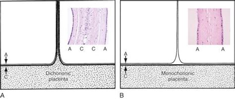 Ultrasound Evaluation In Multiple Gestations Clinical Tree