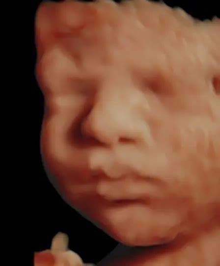 Nuchal Translucency Scan Sydney 12 14 Weeks Cfwu