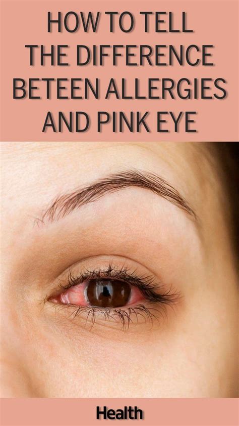 How To Tell The Difference Between Allergies And Pink Eye Artofit