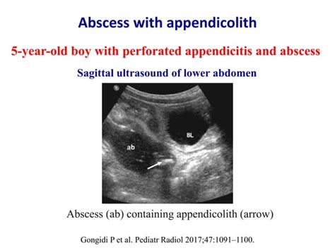 Acute Appendicitis Ultrasound First Pptx Pregnancy Reproductive