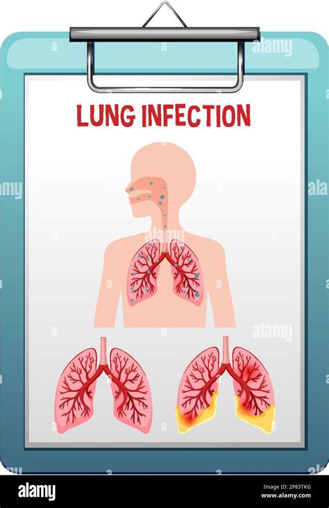 Lung Infection Pneumonia Vector Illustration Stock Vector Image And Art