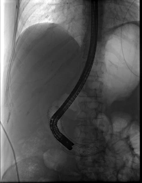 Ercp Showing Limited Viewmaneuverability Of The Duodenoscope Through Download Scientific Ercp Showing Limited Viewmaneuverability Of The Duodenoscope Through Download Scientific