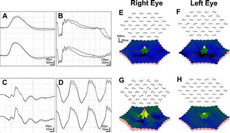 Full Field Electroretinogram Waveforms Obtained 3 Months After The