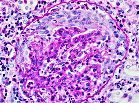 Pathology Outlines Crescentic Glomerulonephritis Overview