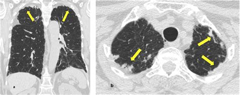 Idiopathic Pleuroparenchymal Fibroelastosis Radiología English Edition