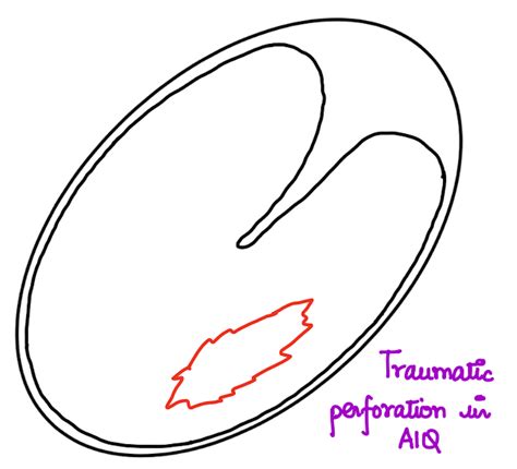How To Draw Tympanic Membrane Perforations Ent Notes And Lectures