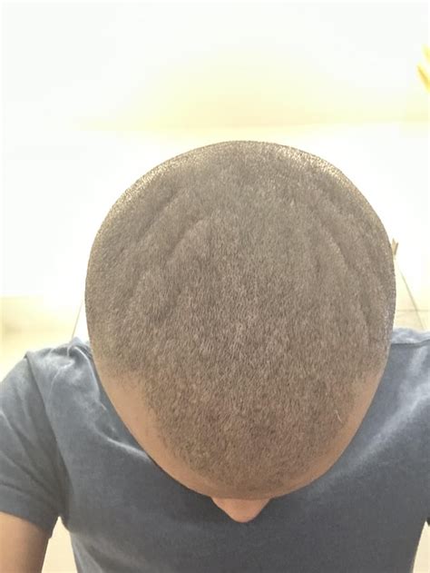 Is This Cvg 20m I Need Your Help Im Freaking Out The Doctor Says Its Just Loose Skin And To