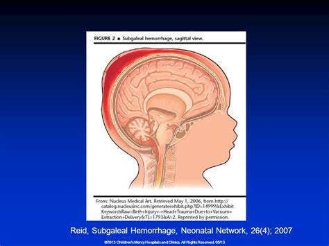 Subgaleal Hemorrhage Regional Neonatal Conference Ppt Video Online Download