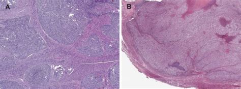 Clinicopathological And Genomic Characterization Of Bcorl1 Driven High