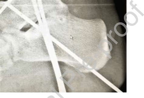 Operative Reduction And Pnning Of The Total Talar Dislocation