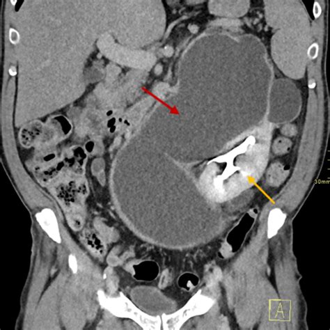 Inflammation Of The Duplicated Renal Collecting System And Ureter With