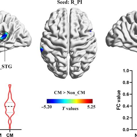 Group Difference In Fc Of Right Pi Between Cm And Non‐cm Groups Voxel