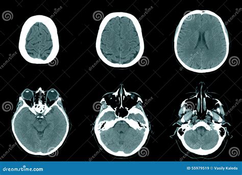 Normal Head On CT Scans Royalty Free Stock Image CartoonDealer Com
