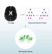 Structured Learning For D Perivascular Spaces Segmentation Using Vascular Features IEEE
