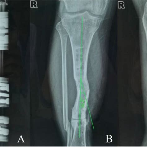 A 41 Year Old Male Patient With Right Tibial Bone Defect Caused By
