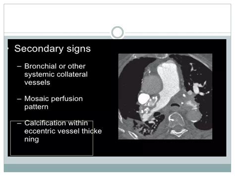 Pulmonary Embolism Radiology Pptx