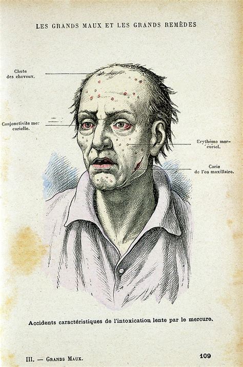 History Of Mercury Poisoning Rarefity