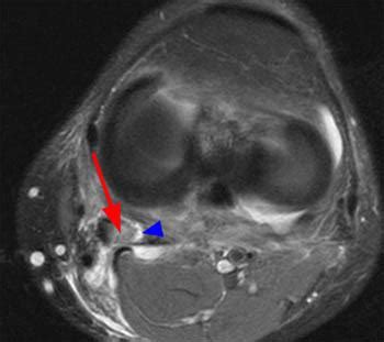 Pes Anserinus Bursitis Radsource