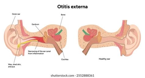 Otitis Externa Anatomy Ear Disease Inflammation Stock Vector Royalty