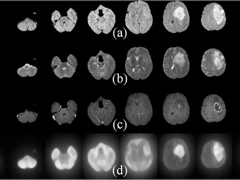 Volumetric Brain Tumour Detection From Mri Using Visual Saliency