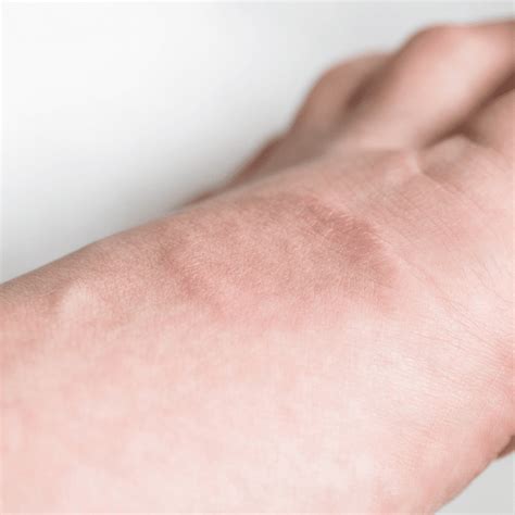 Granuloma Annulare Natural Treatment Dr Kate Smith