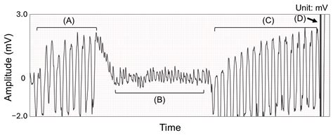 Comparison Of Neural Network Structures For Identifying Shockable