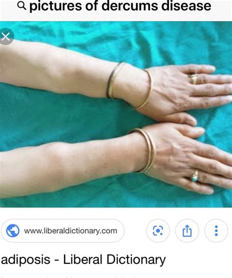 Pin On Zebra Dercums Disease