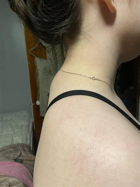 Pseudo Cushings Vs Real Rcushings